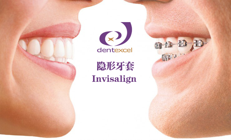 英国牙齿专家Dentexcel | 隐形牙套Invisalign帮你告别钢牙 — Red Scarf